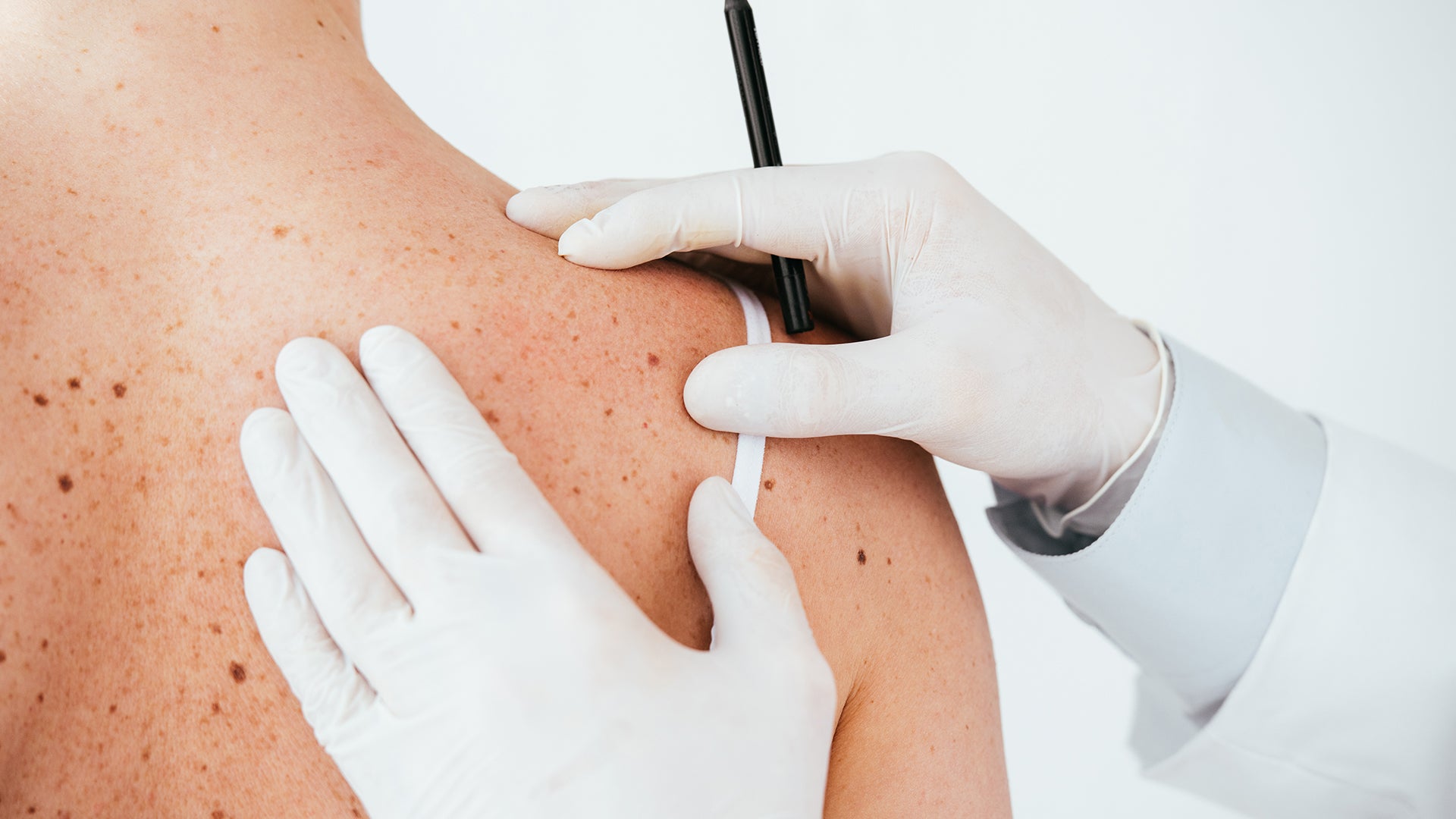 Melanoma skin cancer cases are rising and how my diagnosis nearly 20 y